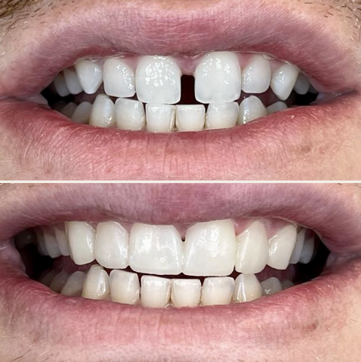 Composite Bonding in Kos Bodrum Holiday +905525324848